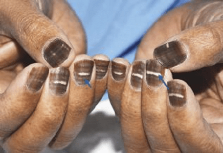 What The Color Of Your Nails Say About Your Health - The Healthcare Guys