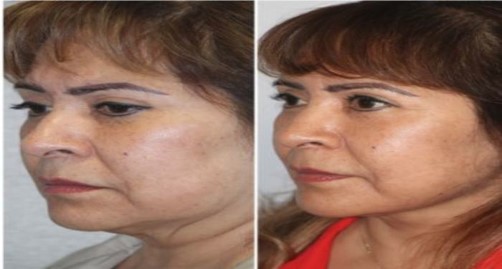 How Can Neck Lift Procedures Rejuvenate Your Overall Look? - The ...