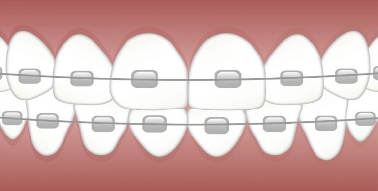 Basic Guide to Dental Braces | The Healthcare Guys